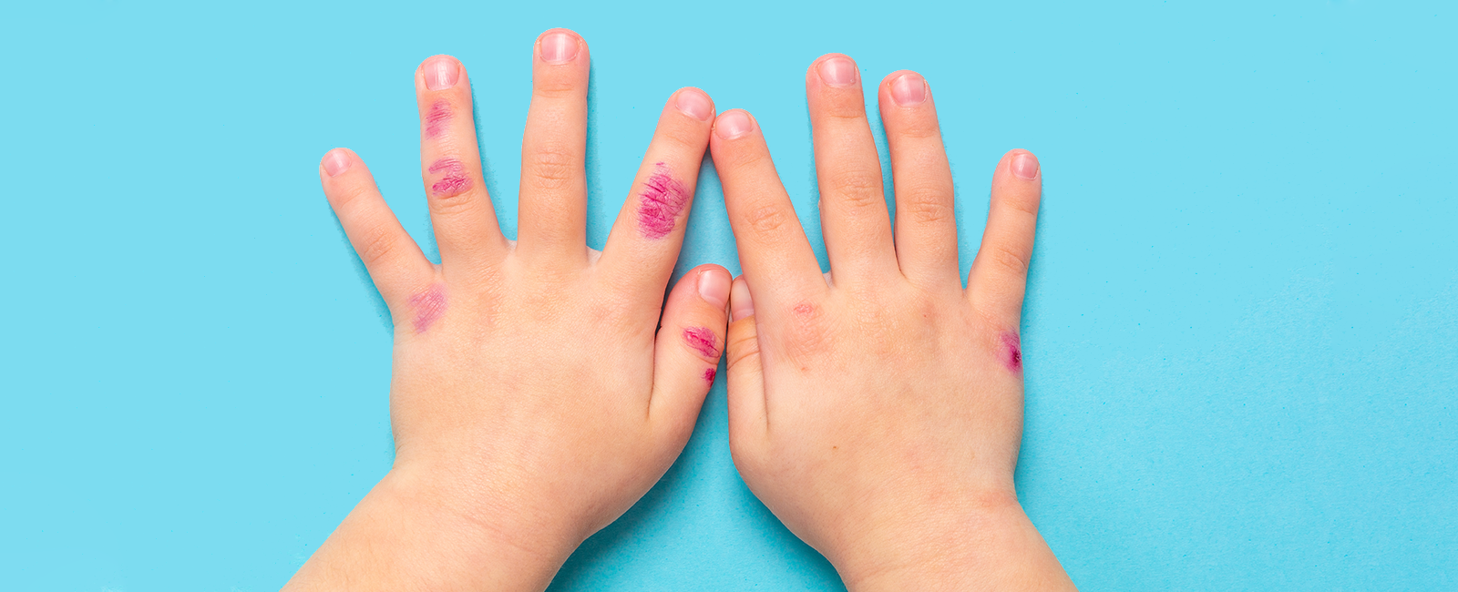 LE PSORIASIS CHEZ L’ENFANT – Ceramol France
